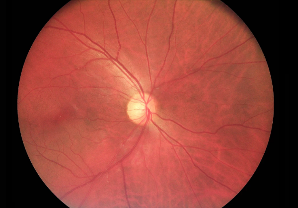 Optomed Aurora – Malaysia Ophthalmic Innovator