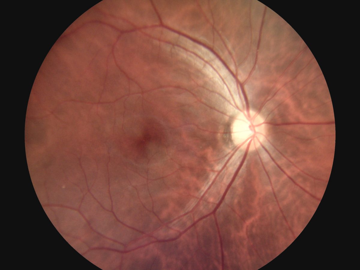 MiiS Horus Digital Fundus Camera DEC 200 (Eye Fundus Camera) – Malaysia ...