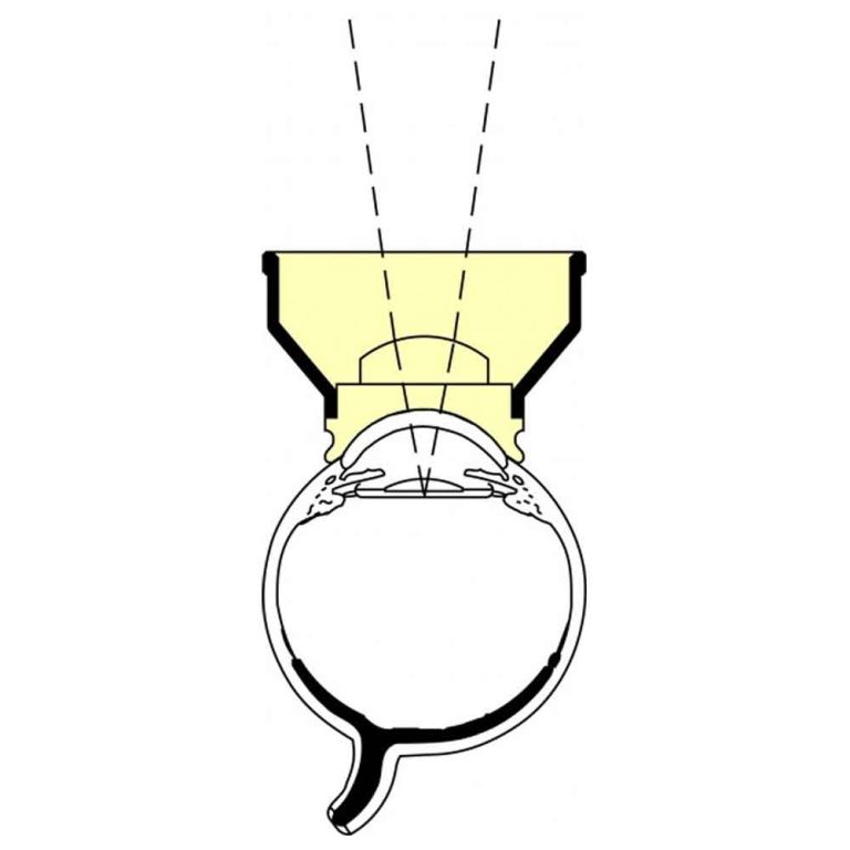 Ocular Abraham Capsulotomy YAG Lens – Malaysia Ophthalmic Innovator